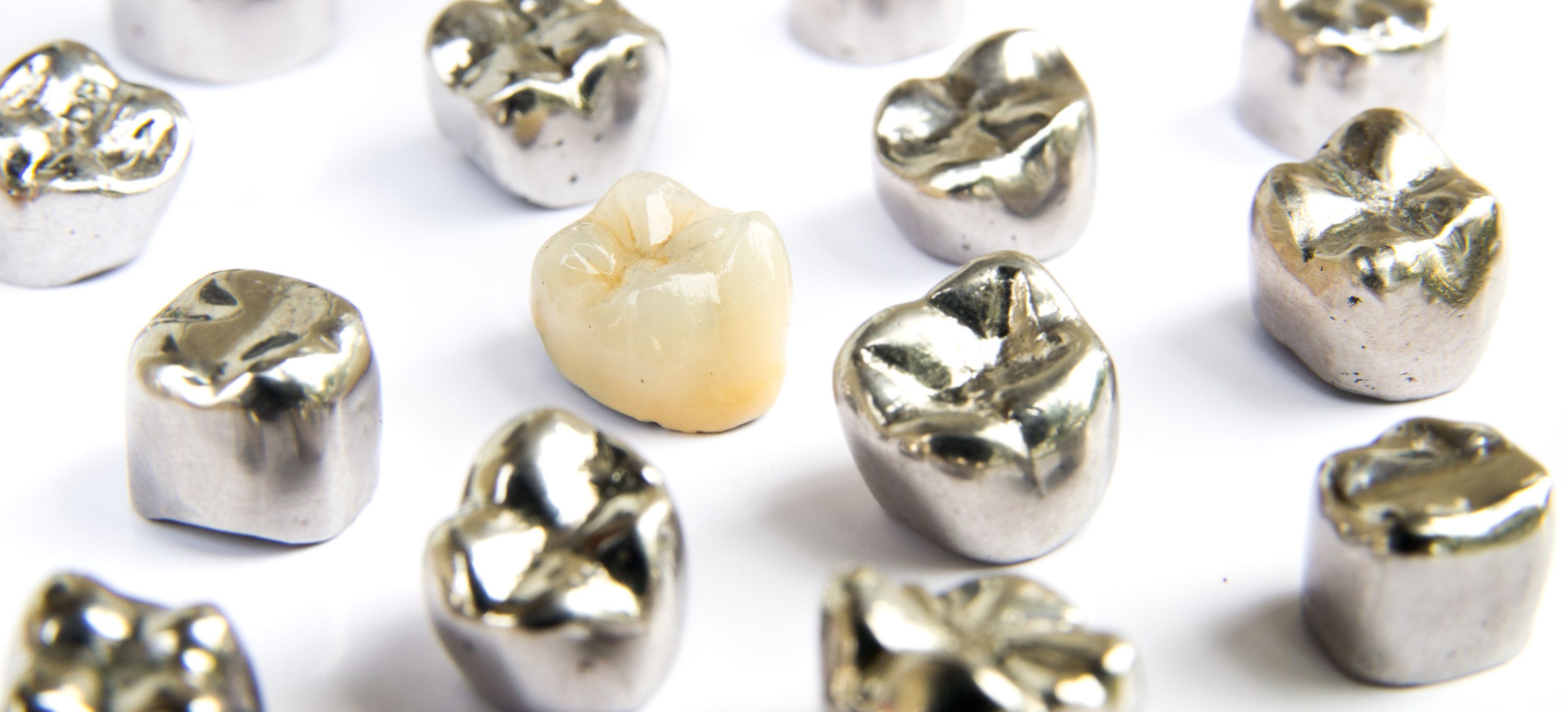 Full Cast Restorations | CDS Dental Studio